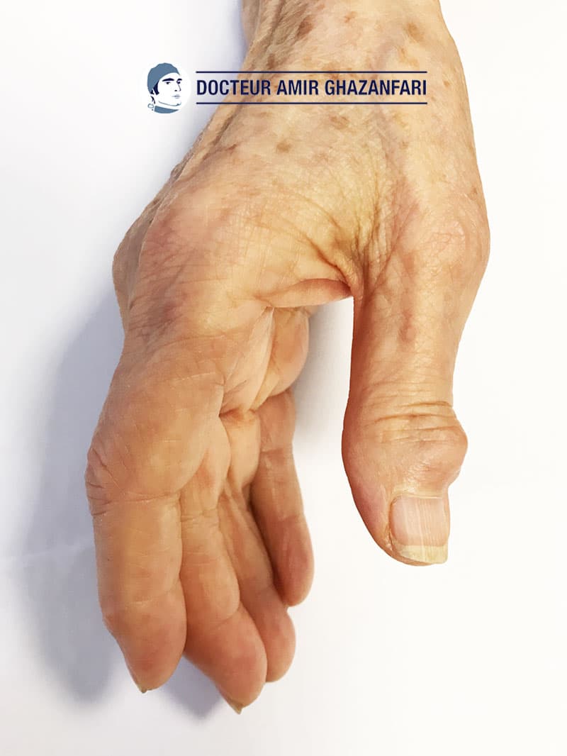 Kystes mucoïde : Diagnostic et traitement