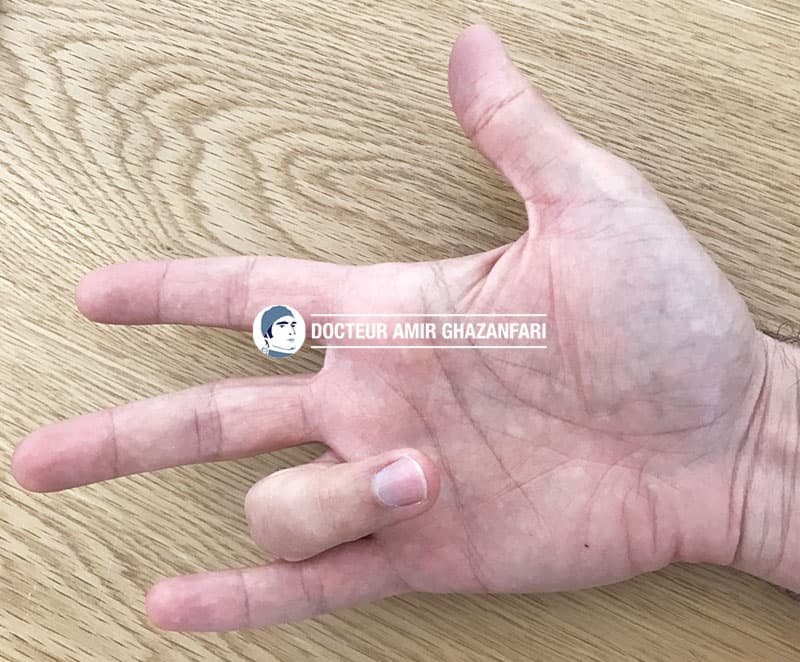 Doigt à ressaut : Diagnostic et traitement