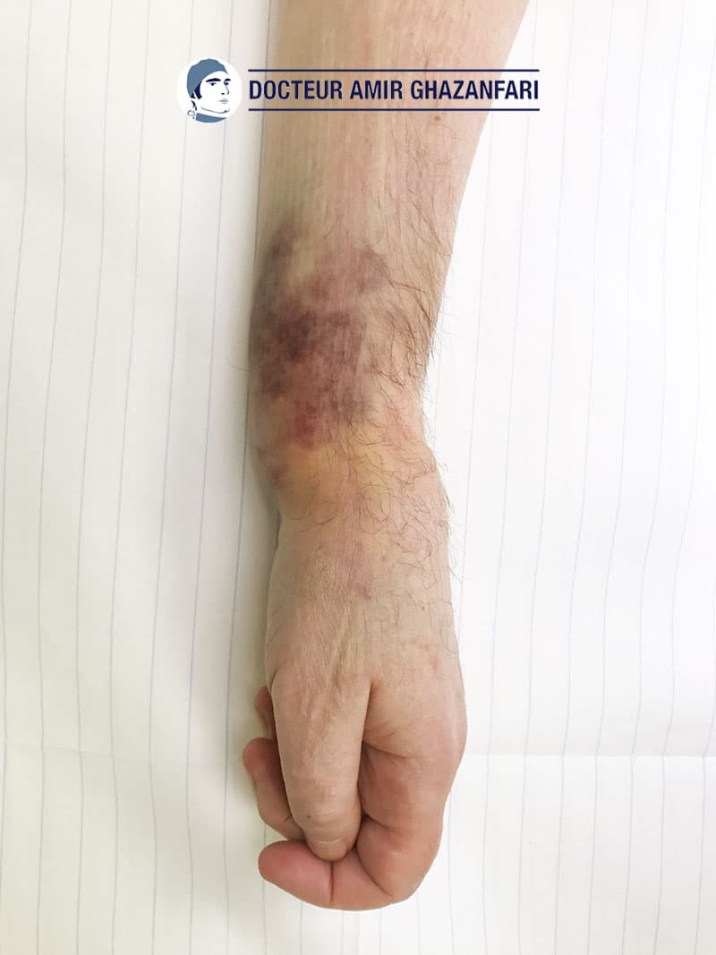 Comment Se Débarrasser D’Une Fracture Du Poignet – LTAX