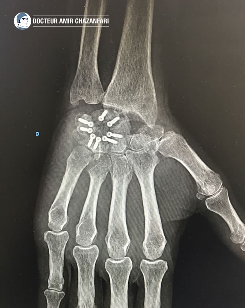 Arthrose du poignet : Diagnostic et traitement